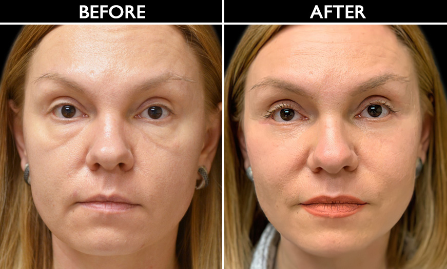 Eyelid Surgery and Festoons NJ | The Botox® Test